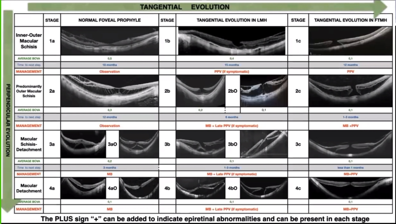 Staging and Managing Myopic Traction Maculopathy - PIE