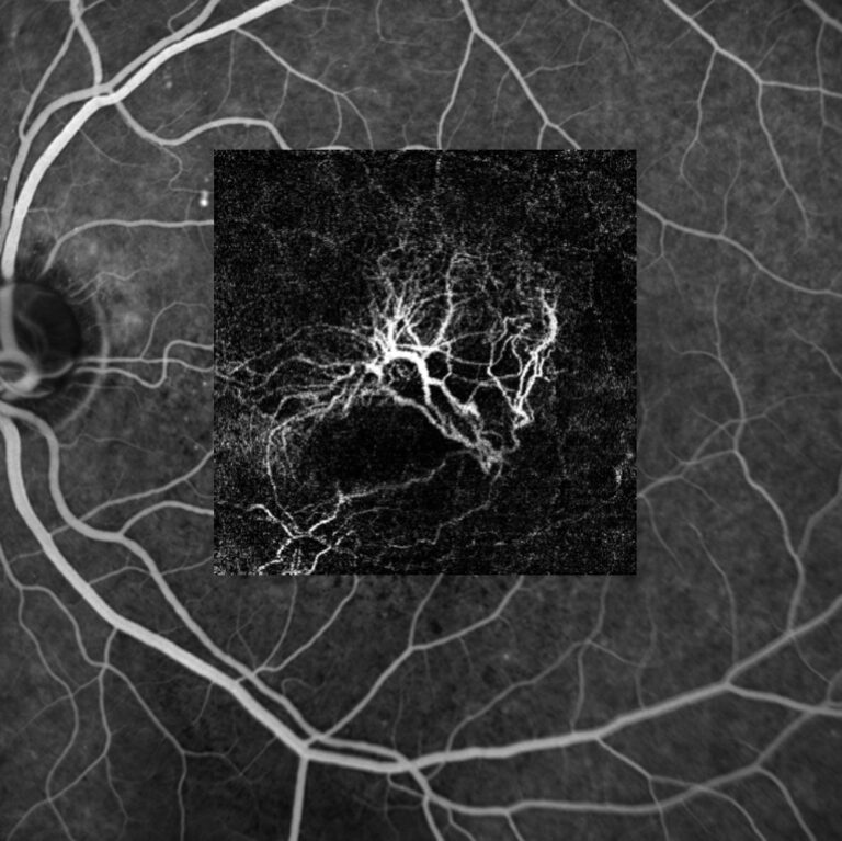 Visualizing the Retinal Vasculature - PIE